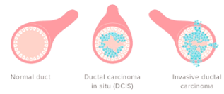 De verschillende borstkankers - MSD Belgium - NL